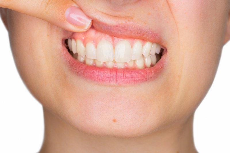 Gum Hygiene Treatment - Moorside Dental